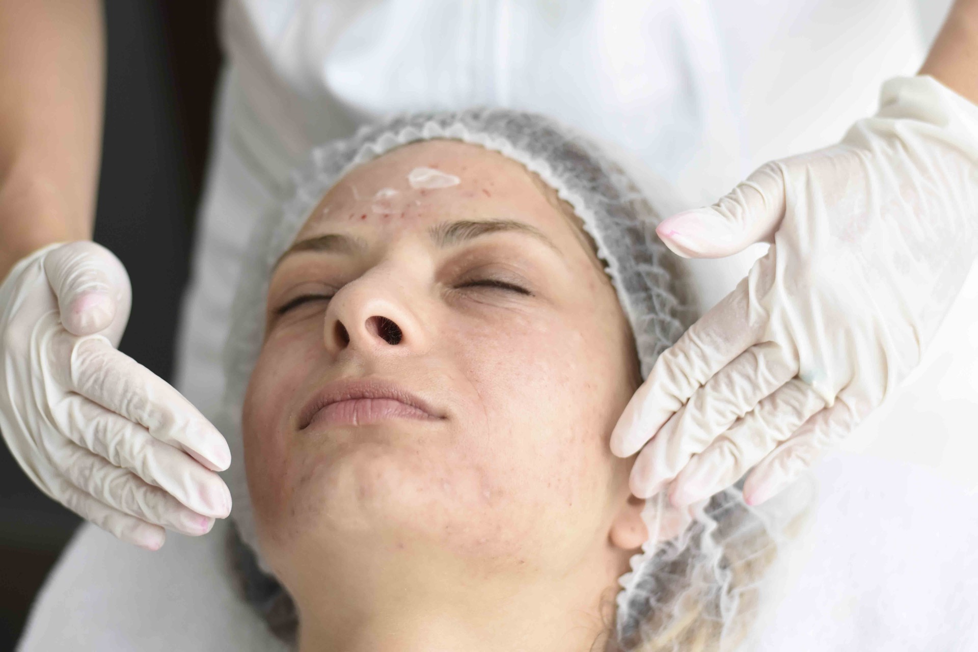 Medicamentosa treatment of acne | Derma Center