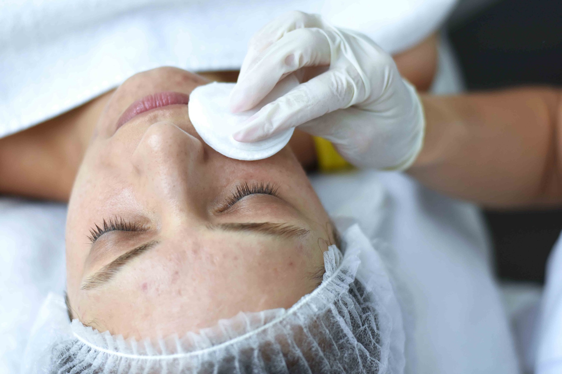 Akné | Derma Center